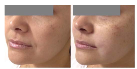 SmoothLiftin Intra-Oral Face Lift in Prince George, BC - Total Body ...